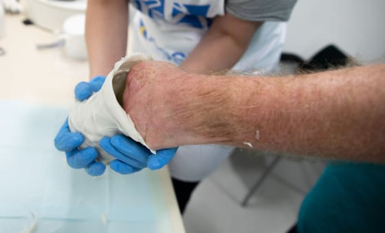 i-Digits Fitting & Fabrication | Össur Academy Touch Solutions