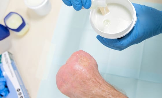 i-Digits Fitting & Fabrication | Össur Academy Touch Solutions