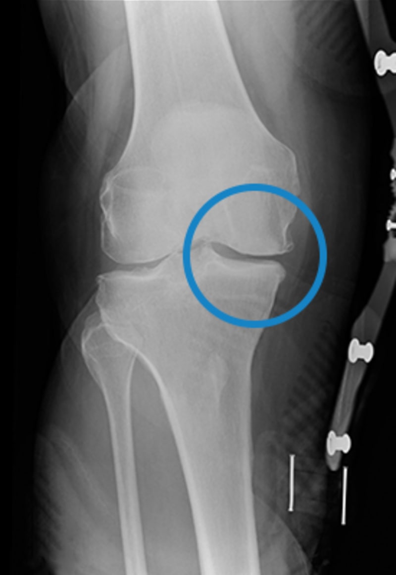 Kniebrace bij artrose | artrose knie brace | valgiserende kniebrace ...