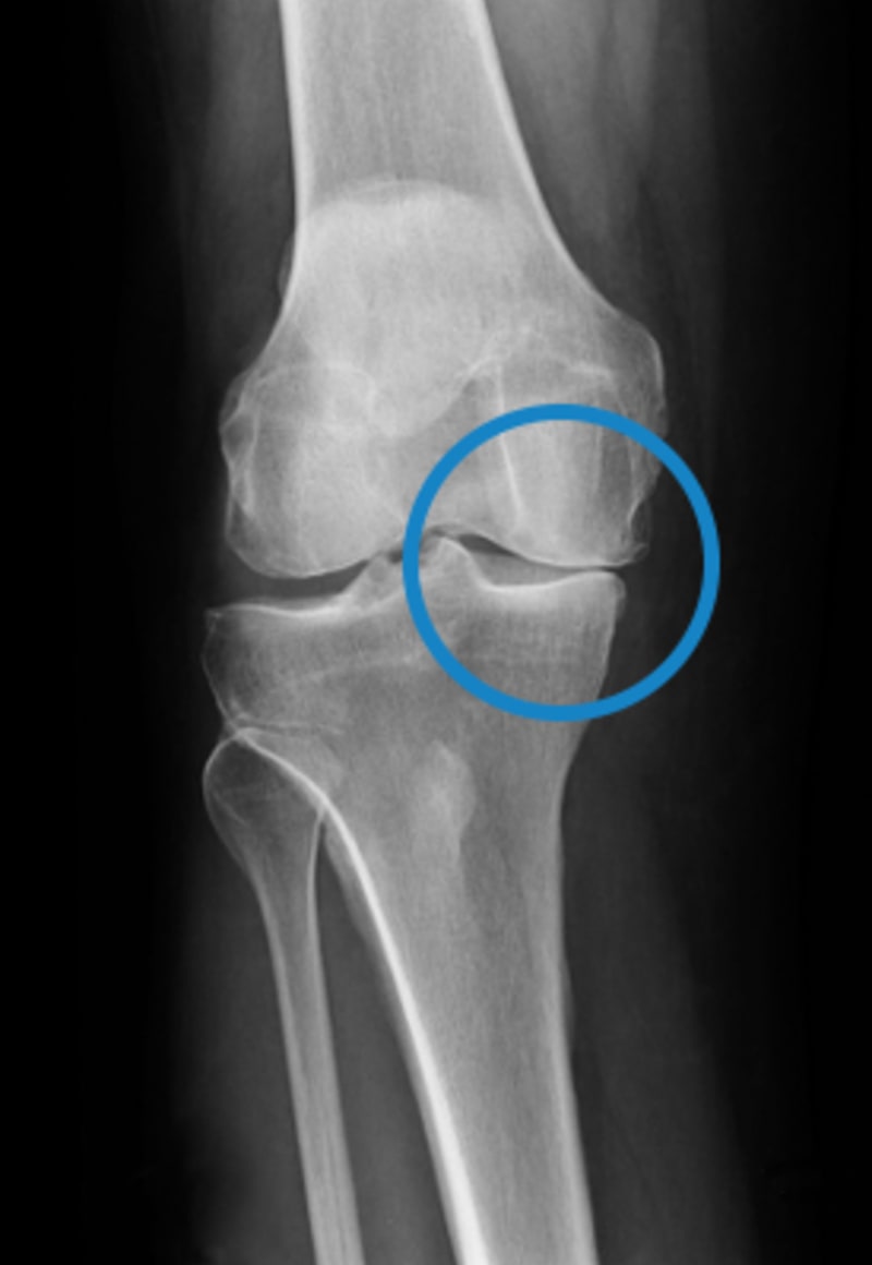 Kniebrace bij artrose | artrose knie brace | valgiserende kniebrace ...