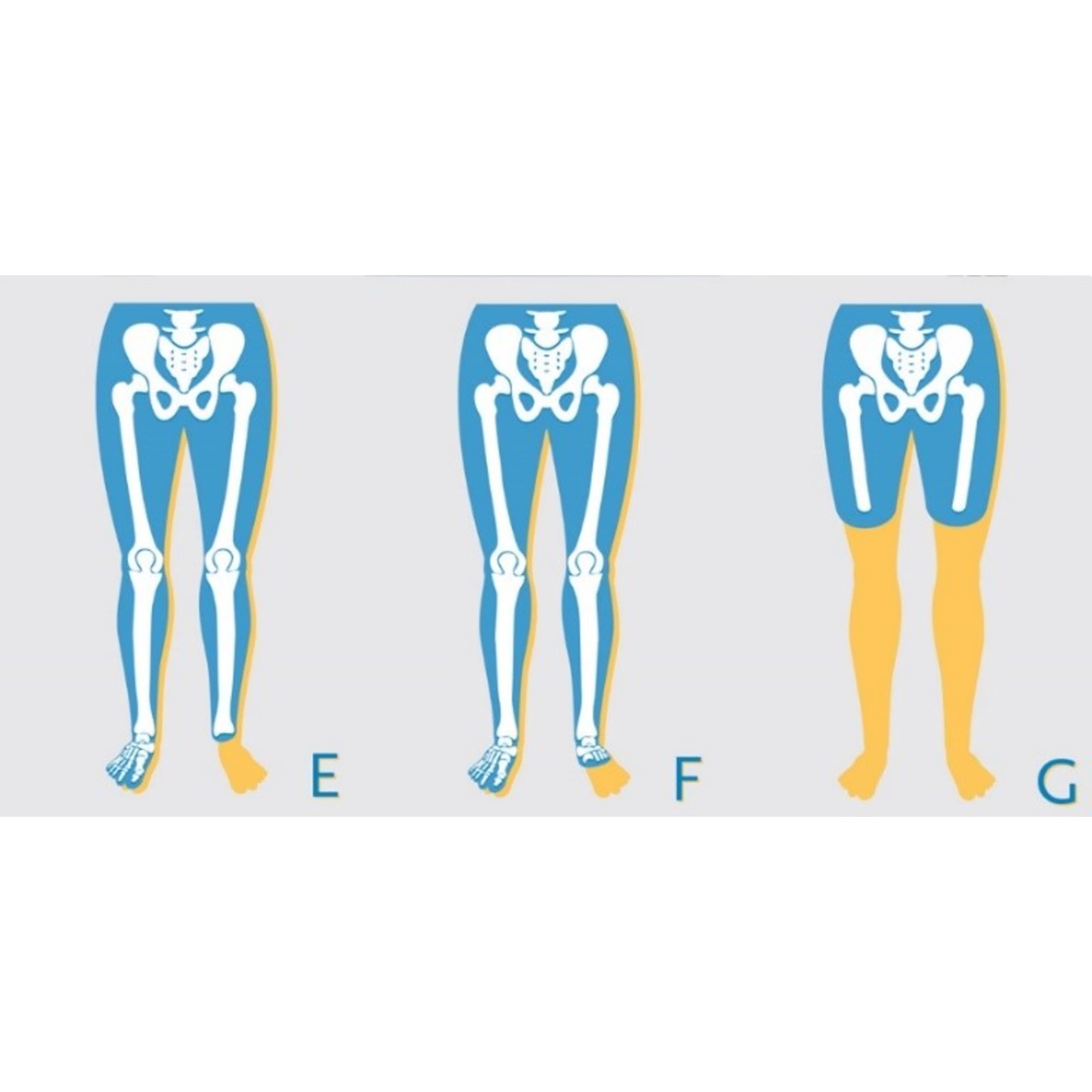 Benamputation | Ossur