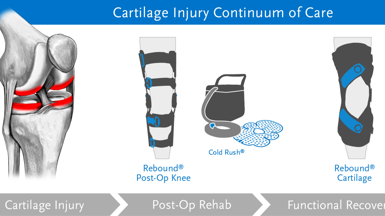 Global Clinician Panel Publishes New Consensus Document On Cartilage ...