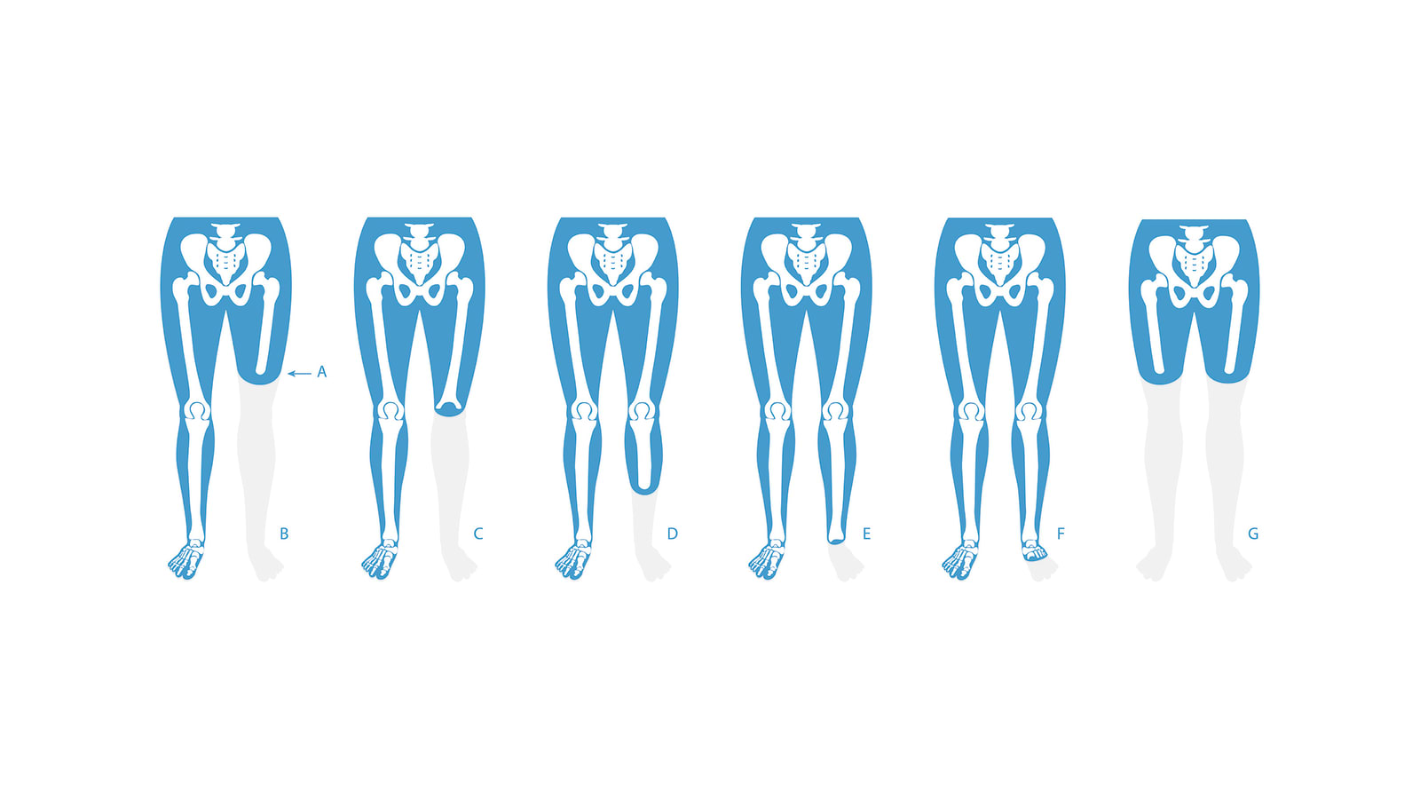 About Leg Amputation. Ossur.com