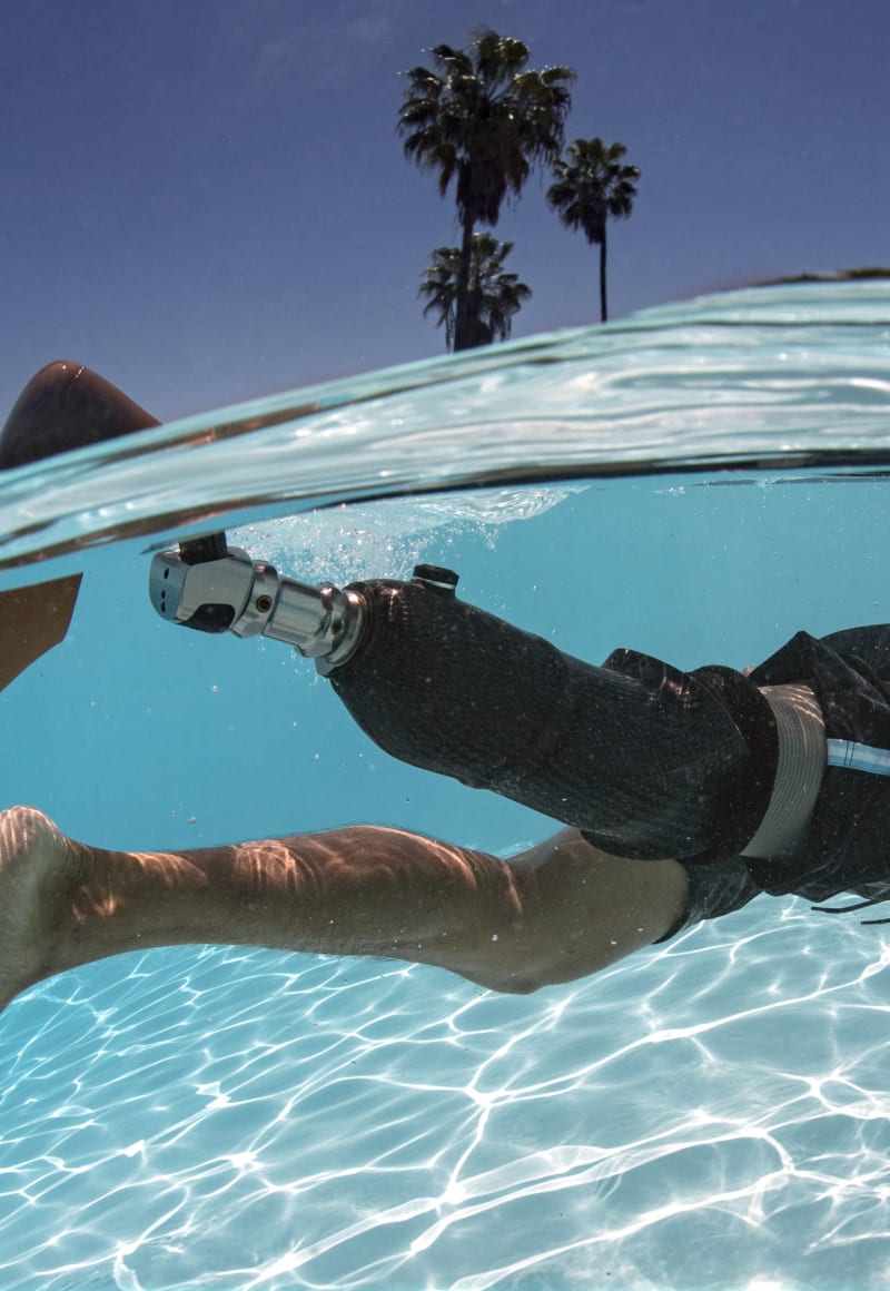 Marta Casado | Prótesis Össur