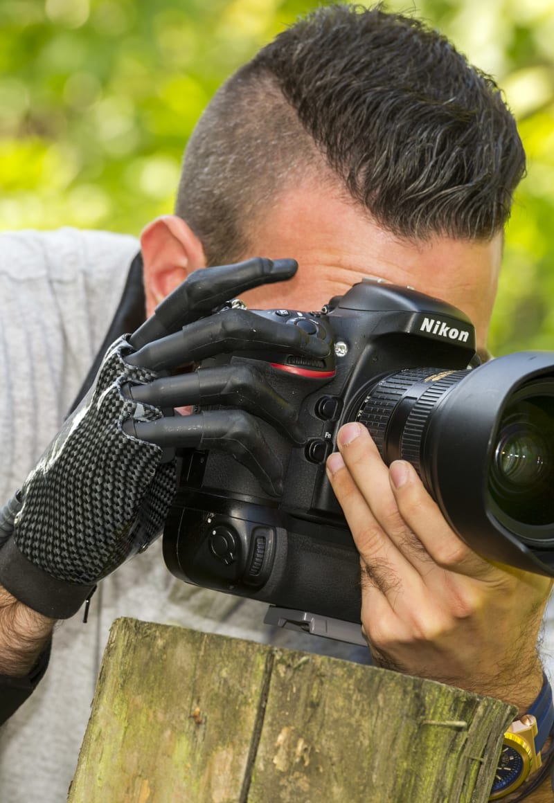 Össur. NHS funding for prosthetic hand. Ossur.com